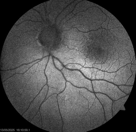 Peripapillary Hyperreflective Ovoid Mass Like Structures Phoms Retinara