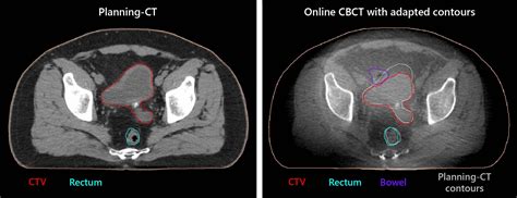 Umc Utrecht Debuts Elekta Cbct Linac For Adaptive Radiotherapy