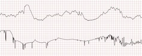 Ventricular Tachycardia Fibrillation Flutter Monomorphic Polymorphic 1