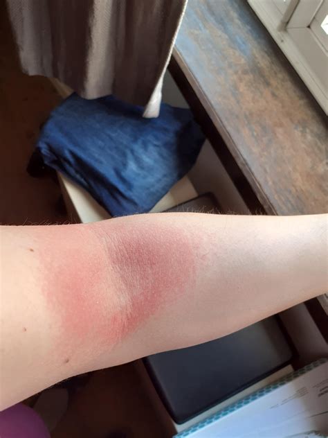 Inner Elbow Rash In Both Arms After Sweating A Lot While Exercising