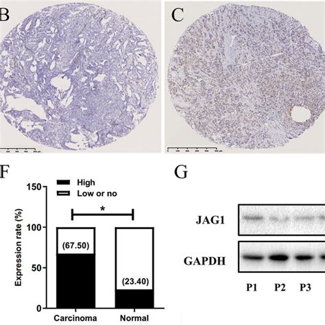 jag1 protein expression in breast tissues a adjacent breast tissue