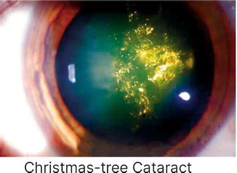 Guide To Cataracts Types Causes Treatment And More