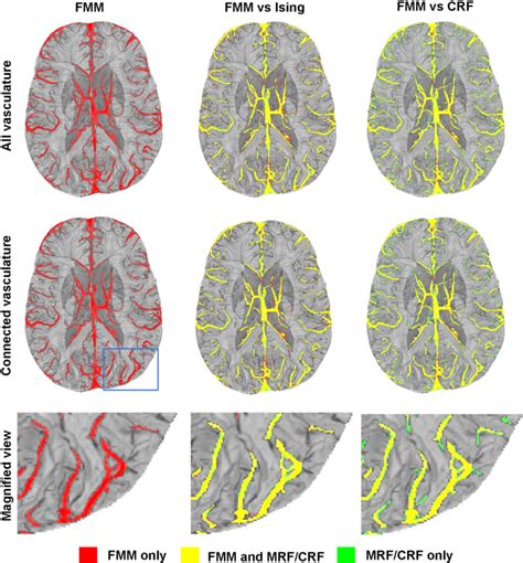 Figure 3 From Automatic Swi Venography Segmentation Using Conditional Random Fields Semantic