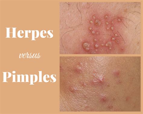 Vaginal Yeast Infection White Bumps