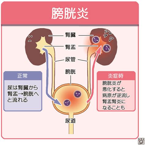 膀胱炎血尿 Ontargive