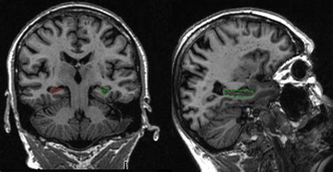 Hippocampal Manual Segmentation Clinical Sciences