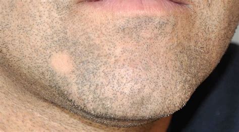 Bald Spot In Beard Under Chin 4 Easy Fixes