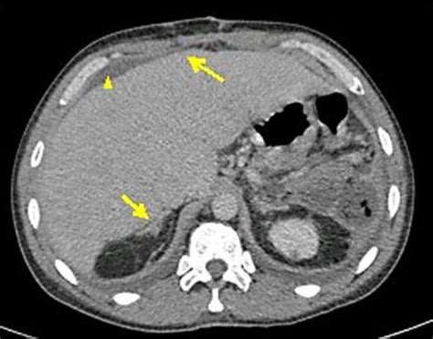 Ct Scan Of The Abdomen Note The Diffuse Heterogeneity Of The Liver Download Scientific Diagram