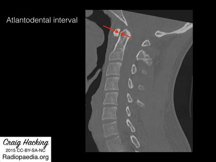 Atlantodental Interval Radiology Reference Article