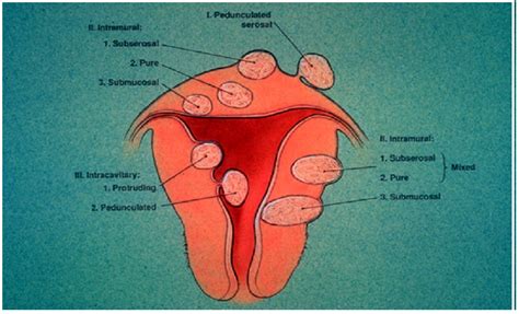 Uterine Fibroid Pictures Anatomy Diagrams Pictures Of