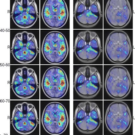 Example Of Preprocessed Datasets Used As Input For The Brain Age