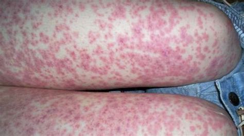 Spilt Milk Meningococcal Warning After Act Music Festival Au — Australias Leading