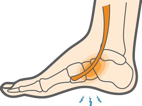 Foot Extensor Tendonitis Taping At Rosa Vega Blog
