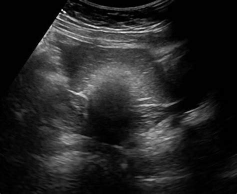 Gynaecology 32 Adnexa Case 322 Dermoid Cysts Cystic Teratomas Ultrasound Cases