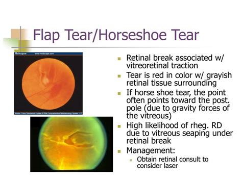 Ppt Vitreous And Peripheral Retinal Anomalies Powerpoint Presentation