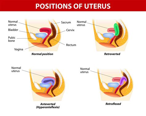 Retroverted Uterus Definition Causes Symptoms