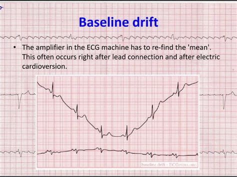 Ecg Artifacts And Pitfalls Pptx