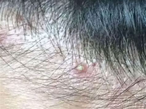 Why Do Pustules And Bumps Always Grow On The Scalp That May Be Related