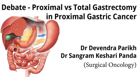 Total Gastrectomy For Stomach Cancer