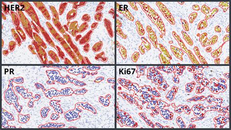 Breast Ihc Ai Indica Labs