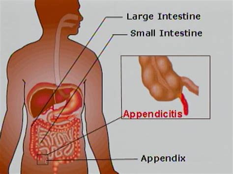 Appendix Symptoms And Treatment ModernHeal Com