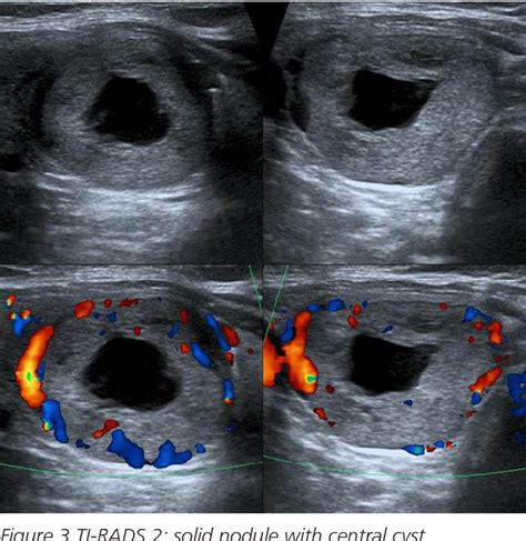 Figure 3 From Ti Rads Classification Of Thyroid Nodules Based On A Score Modified According To