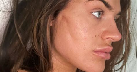 Woman Was Left Like Halloween Character After Botched Thread Lift