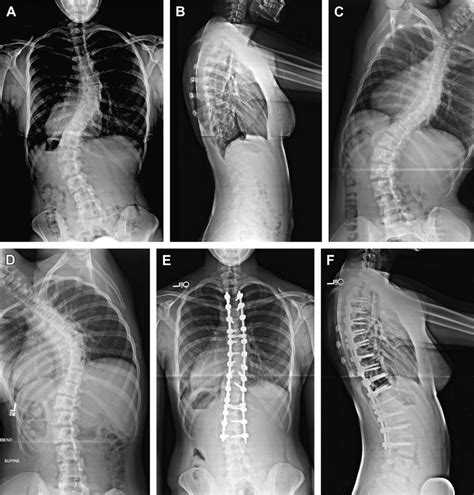 Lenke 6 Preoperative Standing Posteroanterior Pa A And Lateral B
