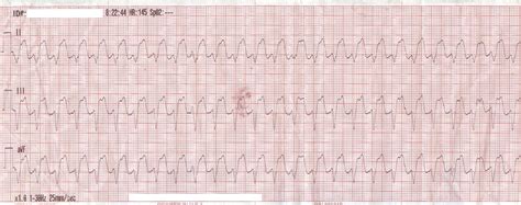 My Variables Only Have 6 Letters Synchronized Cardioversion What Happened