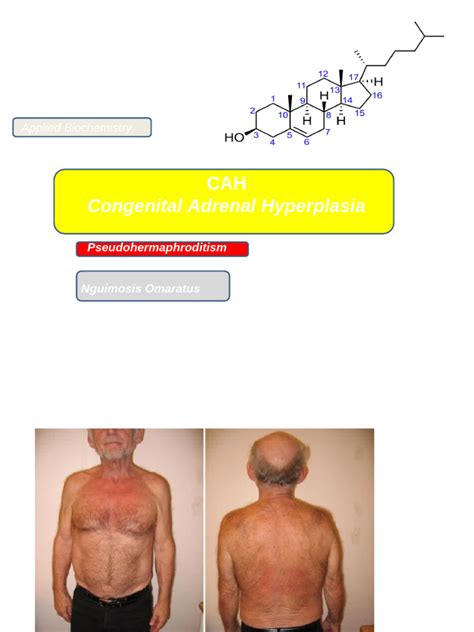 Congenital Adrenal Hyperplasia Pdf Sex Medical Specialties
