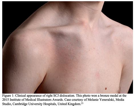 Emergency Medicine Educationsternoclavicular Dislocation Ed Presentation
