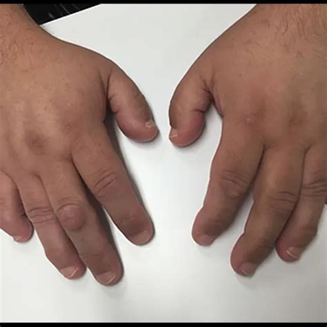 Pseudohypoparathyroidism Explained Causes Symptoms And Diagnosis Ganesh Diagnostic