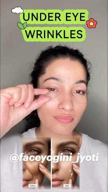 Lift Droopy Hooded Crepey Eyelids Tca Eyelid Lift Artofit