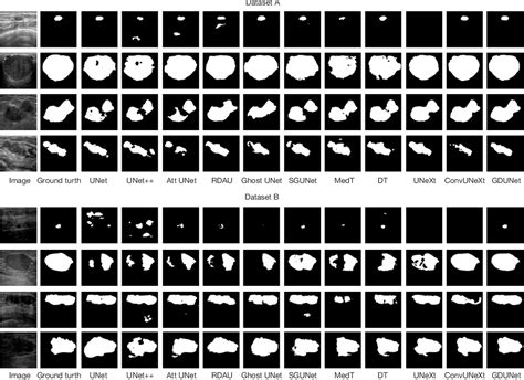Figure 5 From Attention Gate And Dilation U Shaped Network Gdunet An Efficient Breast
