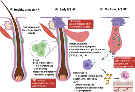 Hidradenitis Suppurativa Tunnels Pictures At Olga Patrick Blog