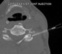 CT Guided Injection Synergy Radiology