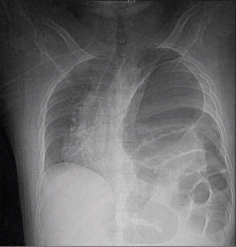 Diaphragmatic Hernia Barrel Chest At Jasper Saranealis Blog