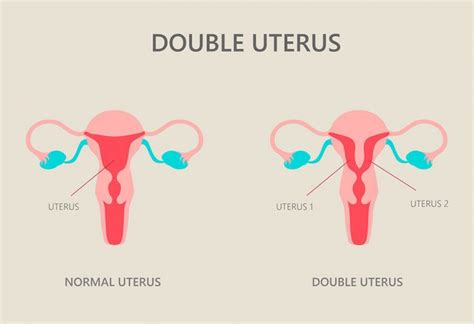Double Uterus Reasons Symptoms Diagnosis And Complications