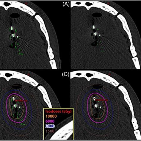 A Mean Absolute Value Seed Migration For A Given Implant For Each