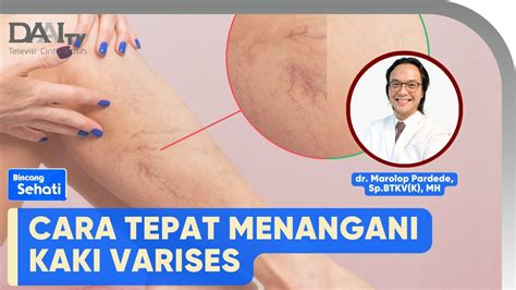 Cara Tepat Menangani Kaki Varises Bincang Sehati Youtube