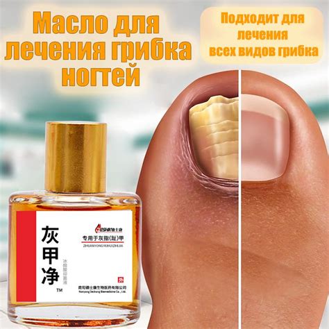 Средство против грибка ногтей на ногах и руках 25 мл Подходит для восстановления и регенерации