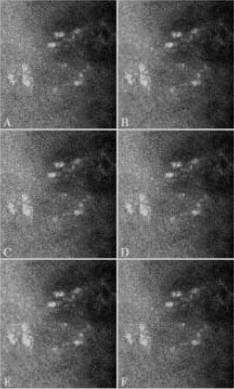 Region Of Interest Containing A Cluster Of Microcalcifications A Download Scientific Diagram