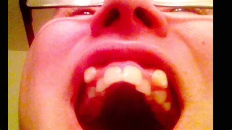 Impact Jacked Up Teeth Testimonial Youtube
