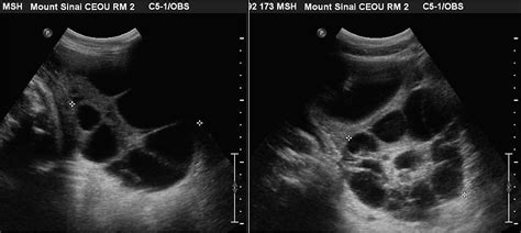 Hyperreactio Luteinalis Maternal And Fetal Effects Journal Of