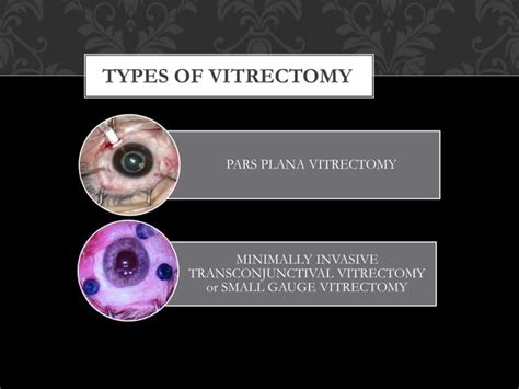 Types Of Vitrectomy Indication S And Complications Pptx