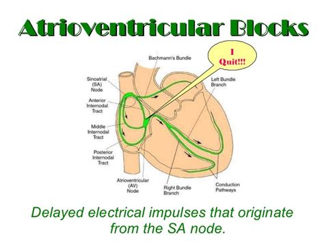 Atrioventricular Blocks Bmh Tele
