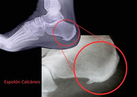 Espolón Calcáneo Causas Síntomas Y Tratamiento