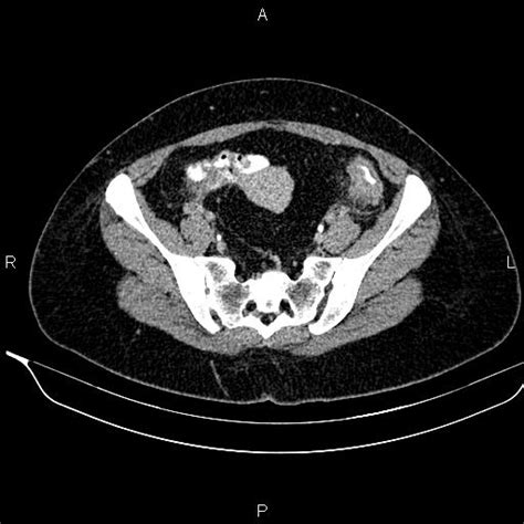 Acute Colonic Diverticulitis Image