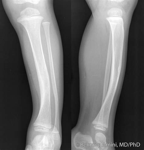 Anterolateral Tibial Bowing Meddic