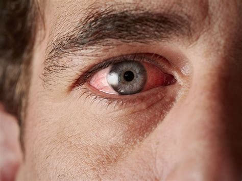 Dry Eye Symptoms And Triggers Acuity Eye Group